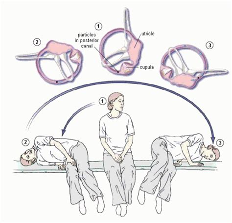 Canalith Repositioning Procedure For Vertigo Active Treatment Of Bppv Artofit