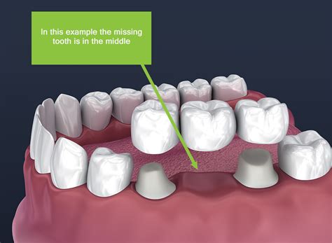 Dental Bridges Chapel House Dentistry
