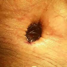 Transcrotal Piercings Wiki The Heavily Modded Amino