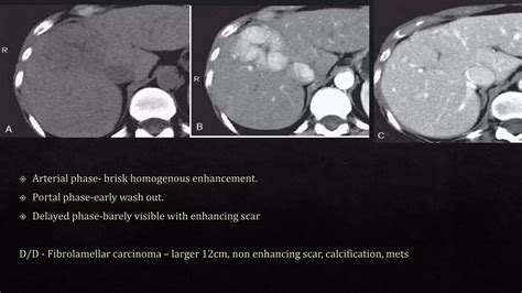 Imaging Of Benign Focal Hepatic Lesions Pptx