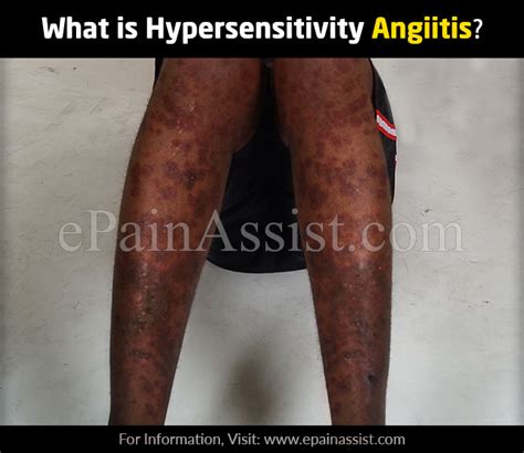 What Is Hypersensitivity Angiitis And How Is It Treatedcauses Symptoms