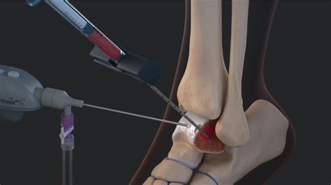 Arthrex Intraosseous Bioplasty® Iobp Technique For Treatment Of