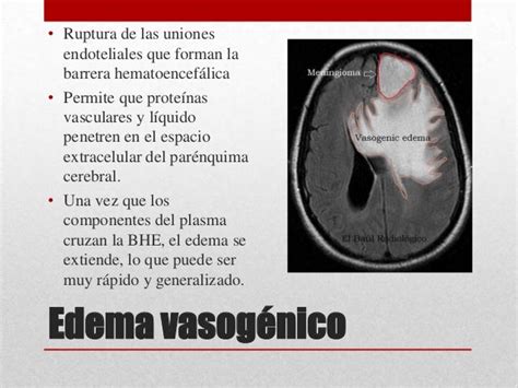 Edema Cerebral