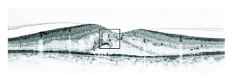 A Representative Case With Hyperreflective Foci Arrowheads In