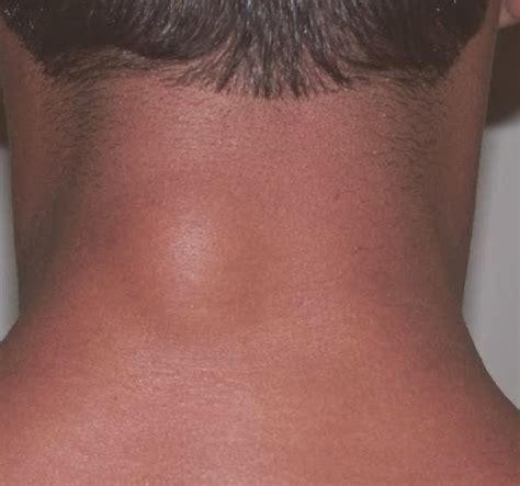 Lipoma Help Lipomas Heres What You Need To Know