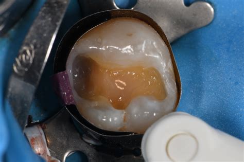 Anatomically Contoured Composite Resin Anatomically Contoured Composite Resin