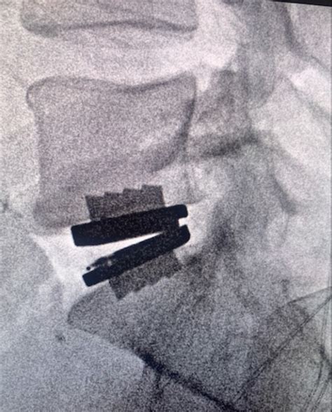 Disc Replacement Lumbar And Cervical Sikora Spine