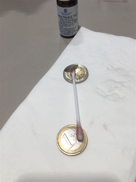 Contact Allergy To Nickel Still 1 After All These Years MDedge Dermatology