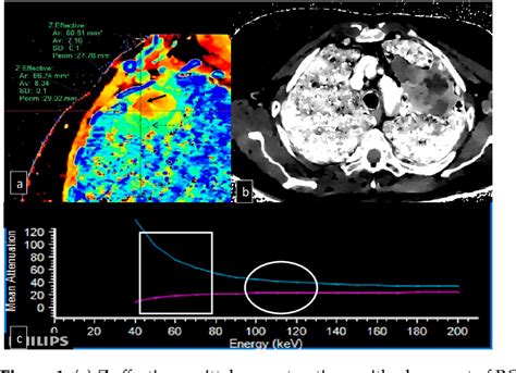 Figure From Dual Layer Spectral Ct As Innovative Imaging Guidance In