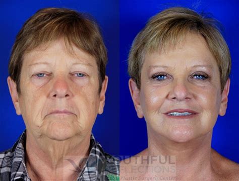 Can Blepharoplasty Be Done Under Local Anesthesia Updated 2024