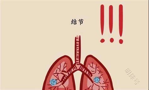 体内有“肺结节”的人，少碰这3种“发物”，转发给家人看看资讯频道东方养生