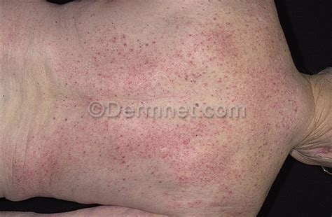 Eczema Disease Classification Using Efficientnet Architecture