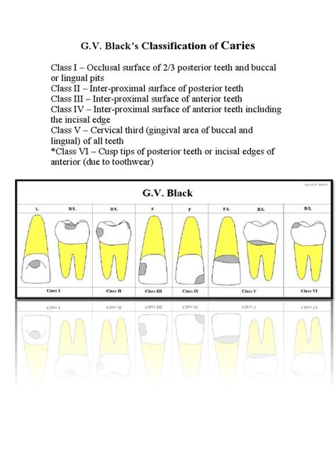 G V Black Caries Classification Pdf
