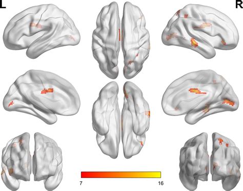 Differences In The Functional Connectivity Of The Right Caudate Nucleus