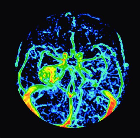 Axial Time To Peak Map From The TRICKS Images The Highly Vascularized Download Scientific