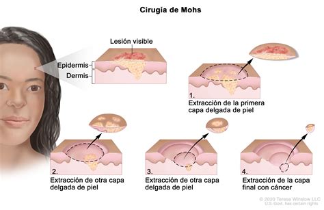 Carcinoma De Células Basales Y Escamosas De Piel Infantil Nci