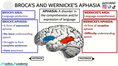 69 Seconds On Brocas And Wernickes Aphasia Never Get Them Mixed Up Again Youtube