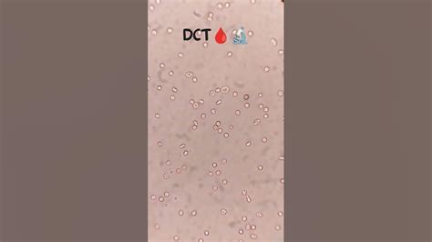Direct Coombs Test Result Under Microscope Hematology Medical