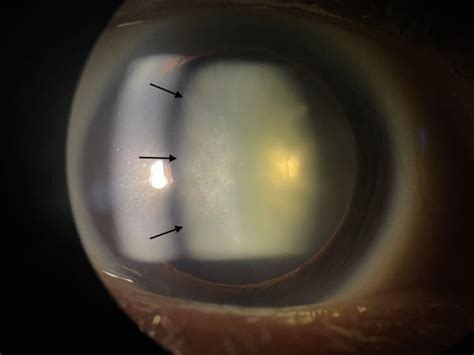 Massager Induced Anterior Subcapsular Cataracts And Keratoconus In A