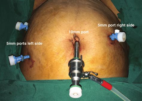 Laparoscopic Assisted Ileocecectomy Hand Assisted Laparoscopic