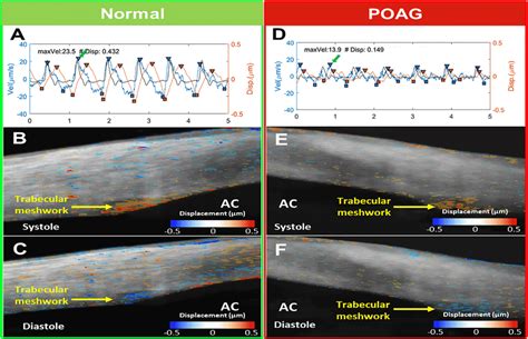 Pulsatile Trabecular Meshwork Tm Movement Waveform Revealed By