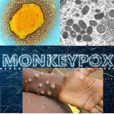 Understanding Mpox Key Information For Protecting Global Public Health