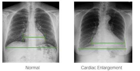 Cardiomegaly Compared To Normal