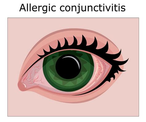 Allergic Conjunctivitis Discharge