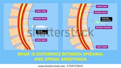 Intrathecal Vs Epidural Injection