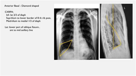 Bronchopulmonary Segments Radiology And Imaging Pptx