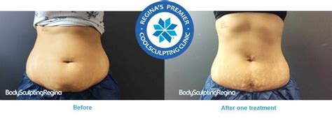 Coolsculping Regina Services In Body Sculpting Regina
