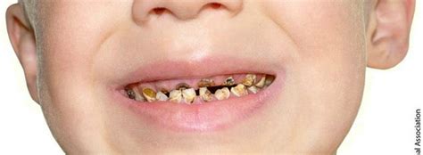 Rotten Teeth