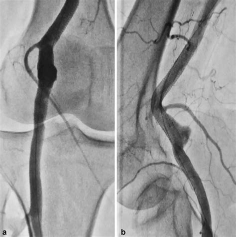 Intraoperative Angiogram Of The Same Patient In Leg Extension A And