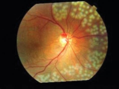 How Does A Retinal Laser Work