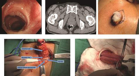 Loop Ileostomy Closure Diseases Of The Colon And Rectum
