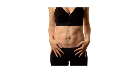 Diastasis Recti What Is It And How To Fix It Videos