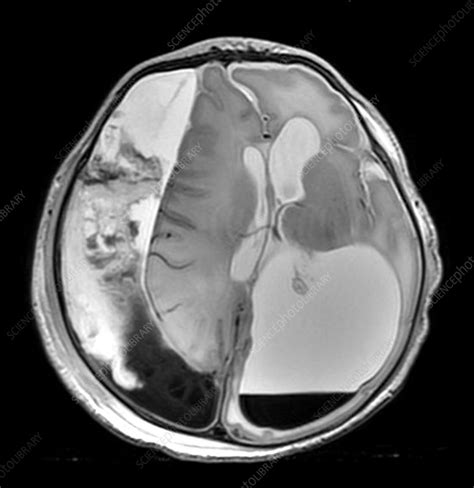 Extensive Birth Injury MRI Stock Image C027 1632 Science Photo
