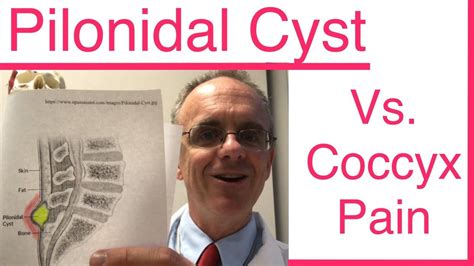 Do You Have A Pilonidal Cyst Or Is It Coccyx Pain Tailbone Pain Youtube