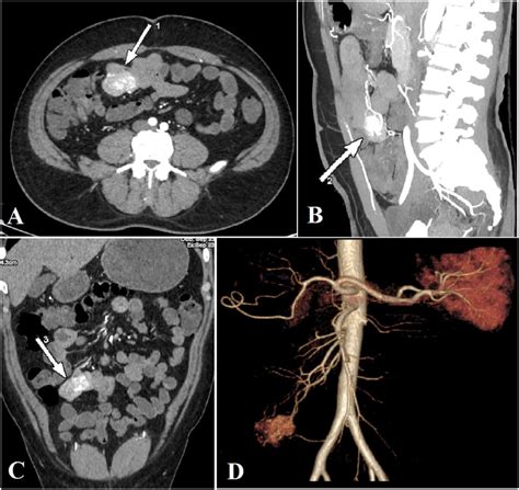 A B And C Triphasic Pelviabdominal Cross Sectional Sagittal And Download Scientific Diagram