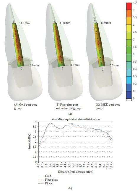 A 3d Finite Element Analysis Of A Tooth Restored With High Performance Polymer Post Core System