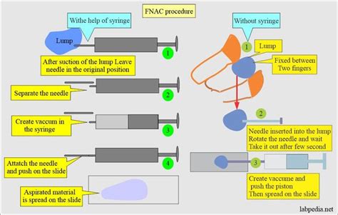 Fine Needle Aspiration Cytology Fnac A Useful Test For Lesion Diagnosis