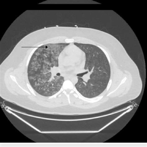 Chest Ct Scan With No Contract Showed Diffuse Ground Glass Opacities