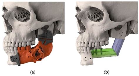 Jcm Free Full Text Accuracy Evaluation Of An Alternative Approach