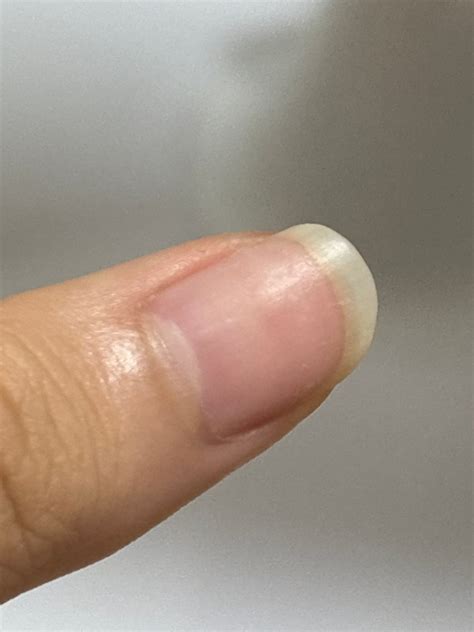 엄지손톱에 튀어나온 줄 지식in