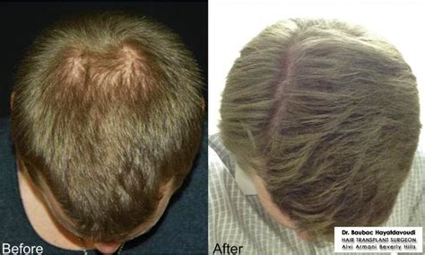 Hair Transplant Infection Pictures Pretty Man Log Book Photographs