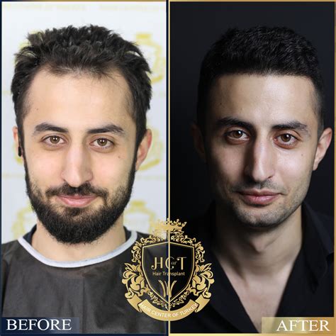 Turkey Hair Transplant Results Hair Transplant In Turkey