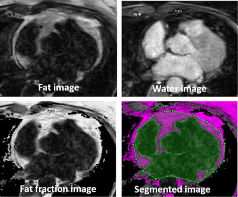 Reconstructed Fat Water Fat Fraction And Segmented Images From A Cine Download Scientific