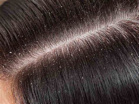 DIAGRAM Diagram Of Dandruff MYDIAGRAM ONLINE