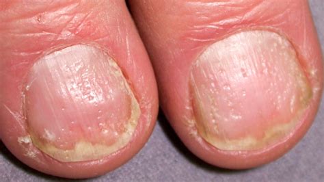 Nail Pitting You Mean The White Dots Rpsoriaticarthritis