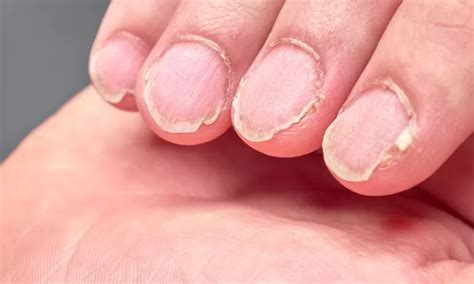 Uñas débiles y quebradizas causas y tratamientos